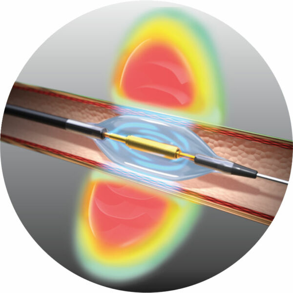 Paradise™ Ultrasound RDN System - RecorMedical
